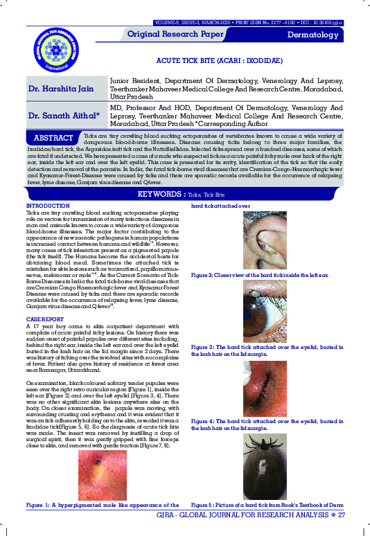(PDF) Acute Tick Bite (Acari : Ixodidae)