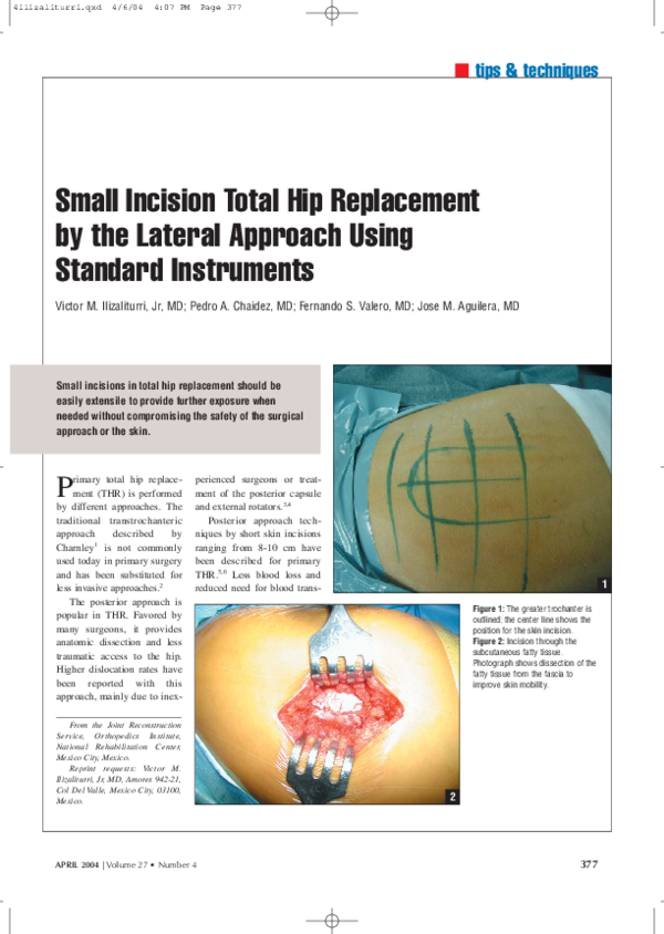 (PDF) Small Incision Total Hip Replacement by the Lateral Approach ...