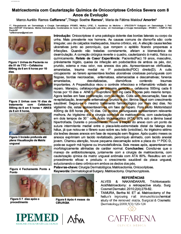 (PDF) Matricectomy with Chemical Cauterization