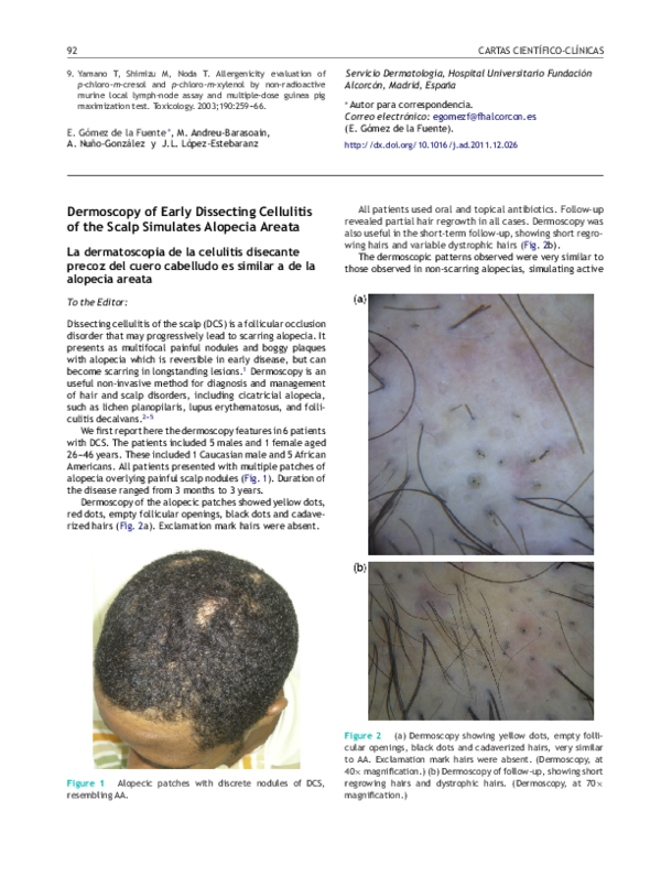 (PDF) Dermoscopy of Early Dissecting Cellulitis of the Scalp Simulates ...