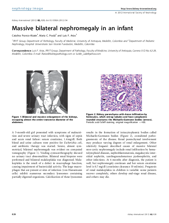 (PDF) Massive bilateral nephromegaly in an infant | Luis Arlexis ...