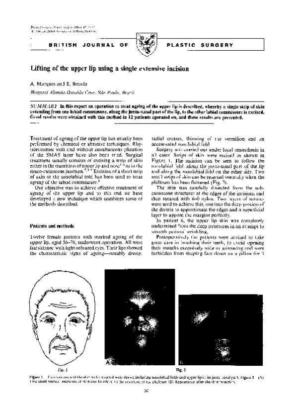 (PDF) Lifting of the upper lip using a single extensive incision