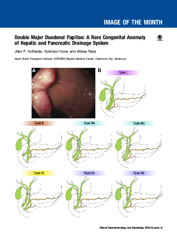 (PDF) Double Major Duodenal Papillae: A Rare Congenital Anomaly of ...