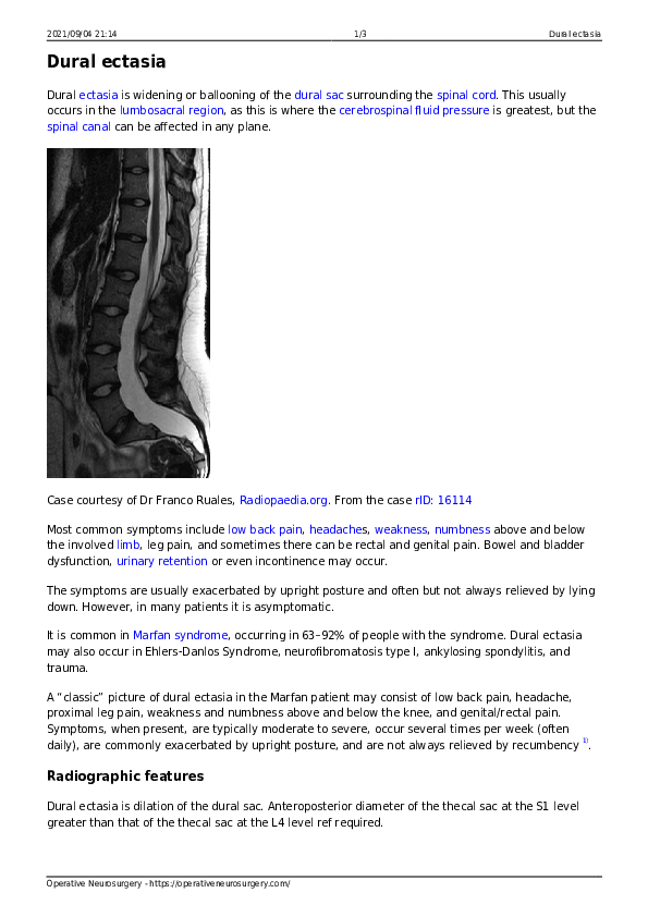 (PDF) Dural ectasia