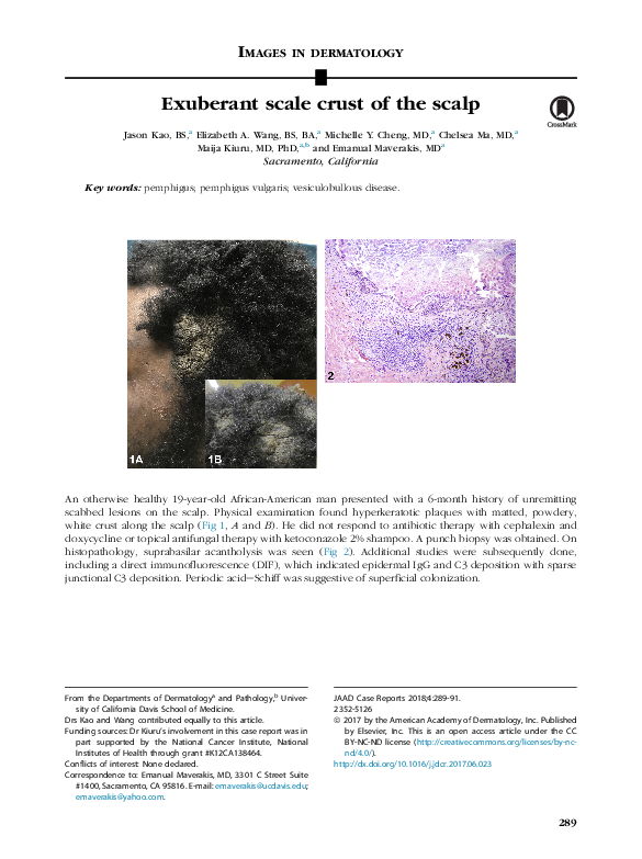 (PDF) Exuberant scale crust of the scalp