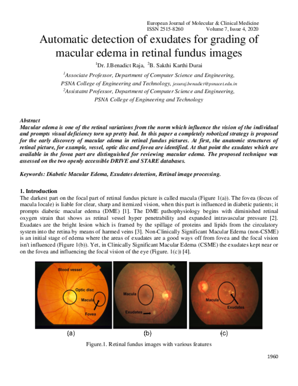 Pdf Automatic Detection Of Exudates For Grading Of Macular Edema In Retinal Fundus Images