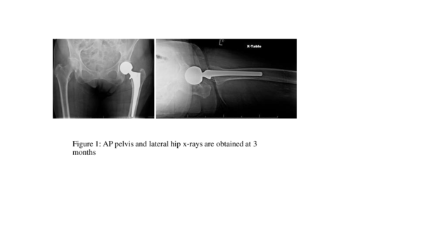 (PDF) Hemiarthroplasty Through a Direct Anterior Approach for Femoral ...