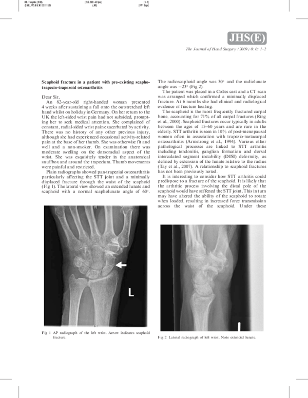 (PDF) Scaphoid fracture in a patient with pre-existing scaphotrapezio ...