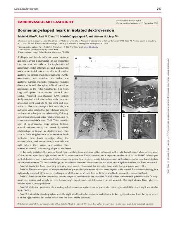 (PDF) Boomerang-shaped heart in isolated dextroversion