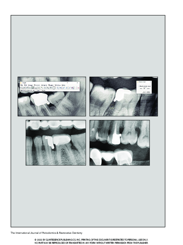 (PDF) Radiographic Evaluation of Marginal Bone Height and Density ...