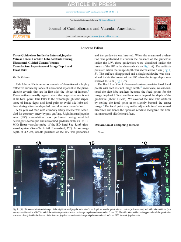 (PDF) Three Guidewires Inside the Internal Jugular Vein as a Result of ...