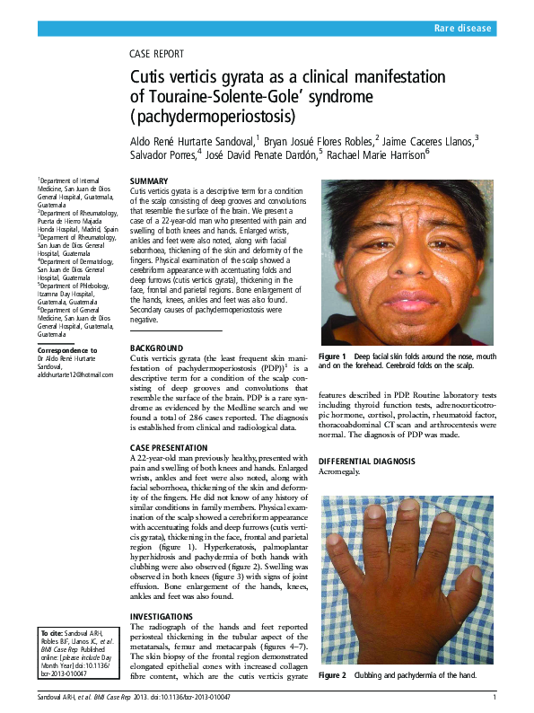 (PDF) Cutis verticis gyrata as a clinical manifestation of Touraine ...