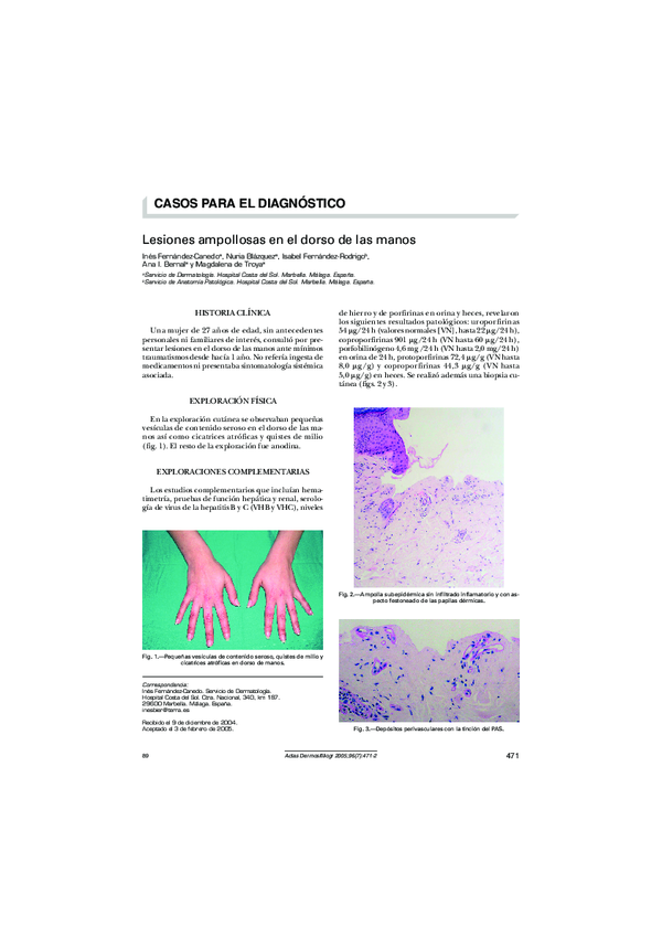 (PDF) Lesiones ampollosas en el dorso de las manos