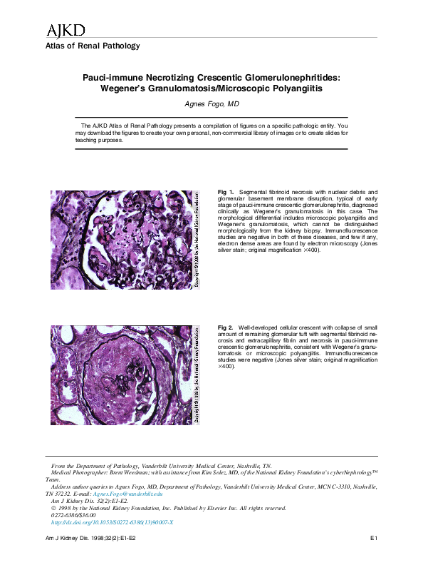 (PDF) Pauci-immune Necrotizing Crescentic Glomerulonephritides: Wegener ...