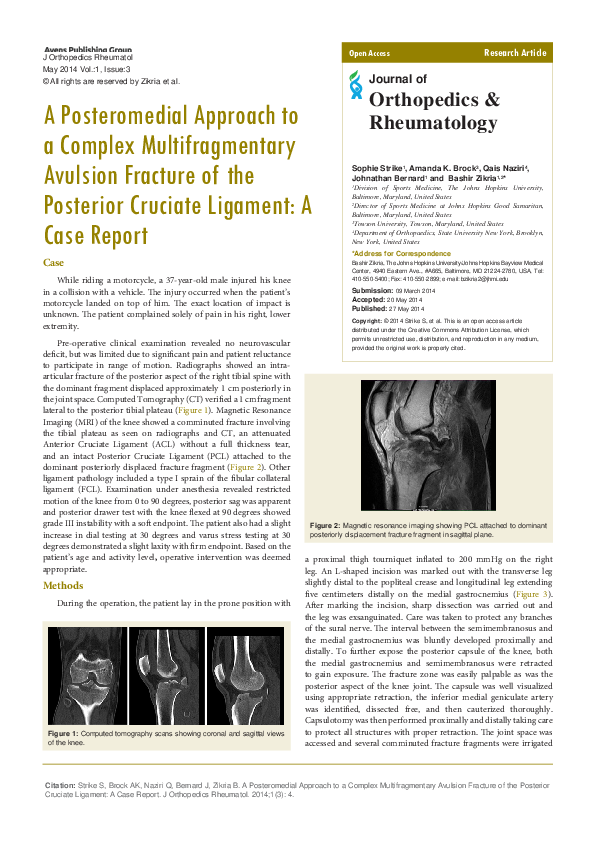 (PDF) A Posteromedial Approach to a Complex Multifragmentary Avulsion ...