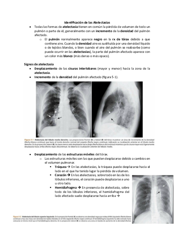 (PDF) Identificación de las Atelectasias