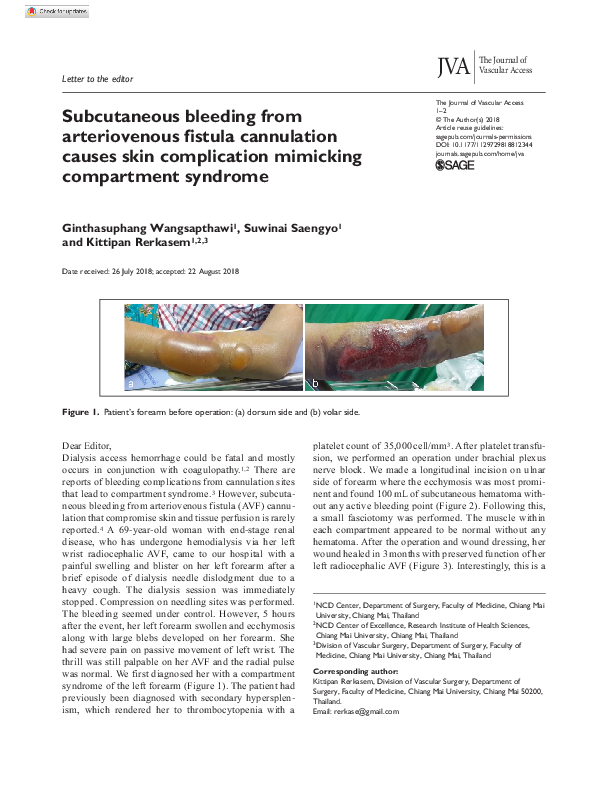 (PDF) Subcutaneous bleeding from arteriovenous fistula cannulation ...