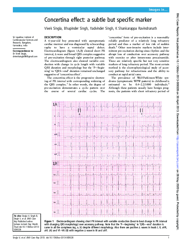 (PDF) Concertina effect: a subtle but specific marker