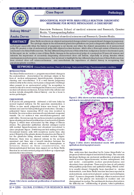 (PDF) Endocervical polyp with Arias Stella Reaction: Diagnostic nightmare for novice pathologist ...