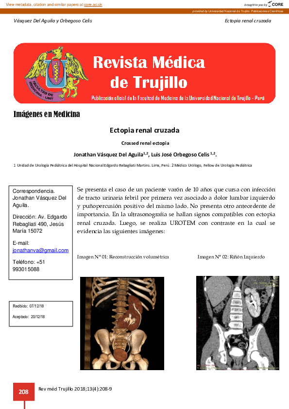 (PDF) Ectopia renal cruzada