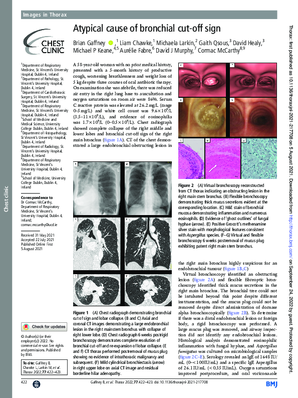 (PDF) Atypical cause of bronchial cut-off sign