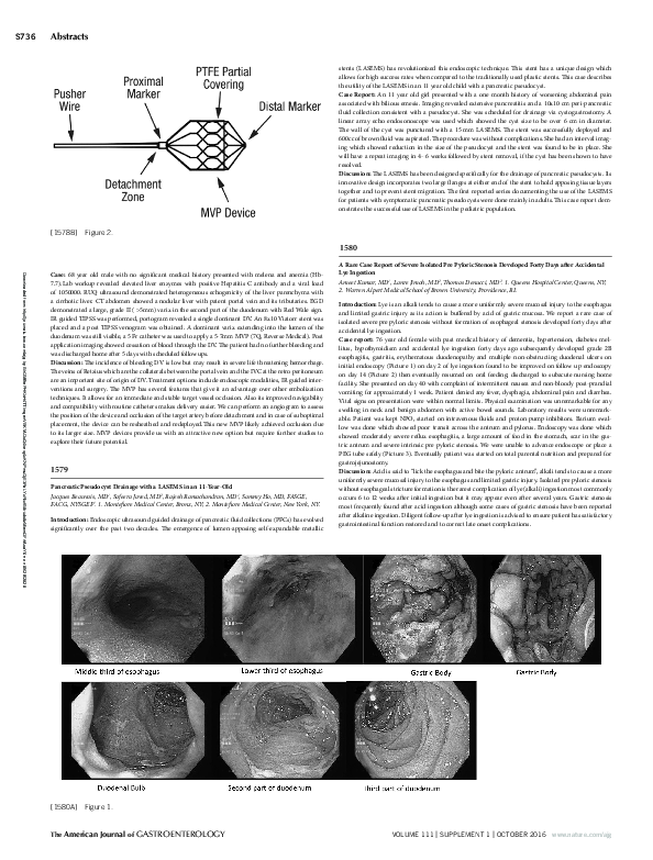 (PDF) A Rare Case Report of Severe Isolated Pre Pyloric Stenosis ...