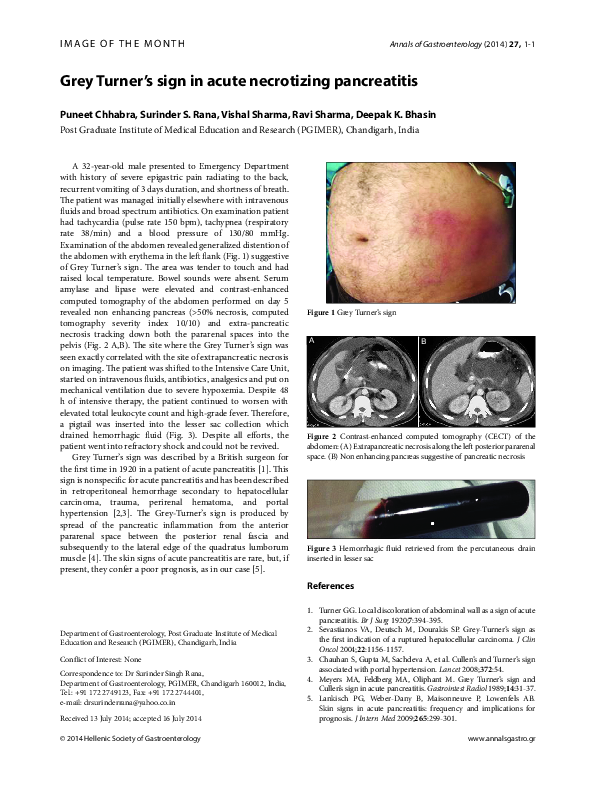 (PDF) Grey Turner's Sign: Prognosis in Pancreatitis