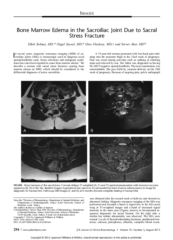 (PDF) Bone Marrow Edema in the Sacroiliac Joint Due to Sacral Stress Fracture