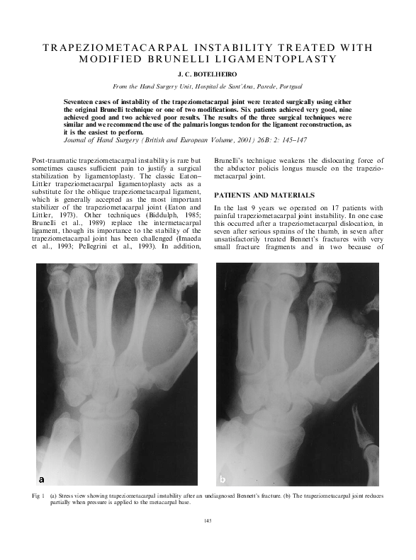 (PDF) Trapeziometacarpal Instability Treated with Modified Brunelli ...
