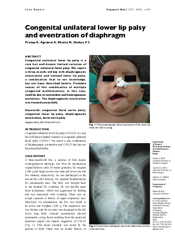 (PDF) Congenital unilateral lower lip palsy and eventration of diaphragm