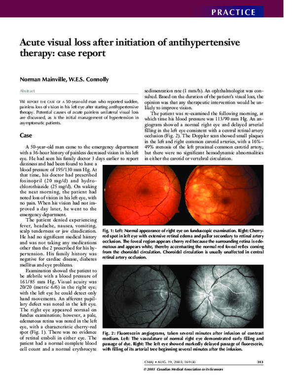 (PDF) Acute visual loss after initiation of antihypertensive therapy ...