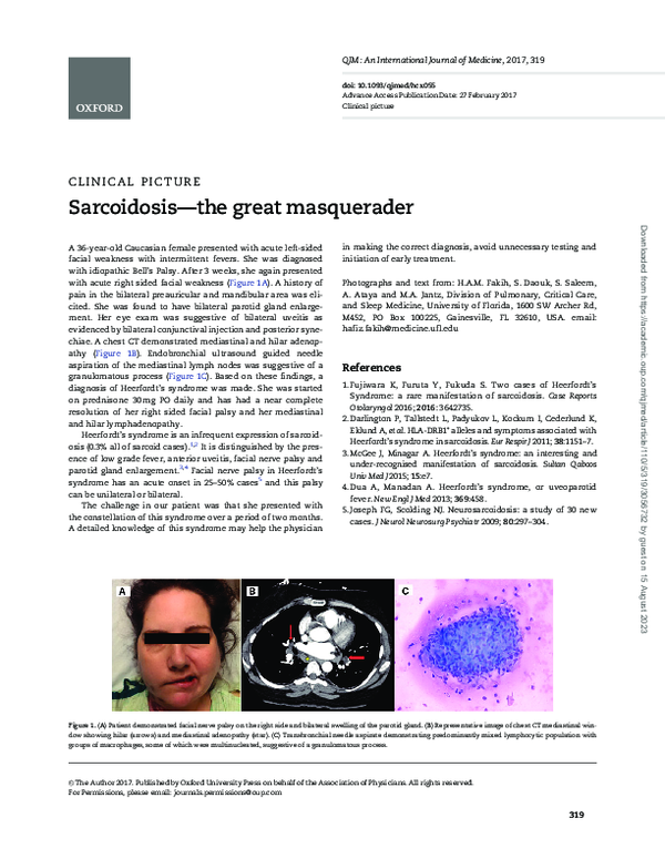 (PDF) Sarcoidosis—the great masquerader