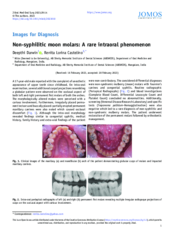 (PDF) Non-syphilitic moon molars: A rare intraoral phenomenon