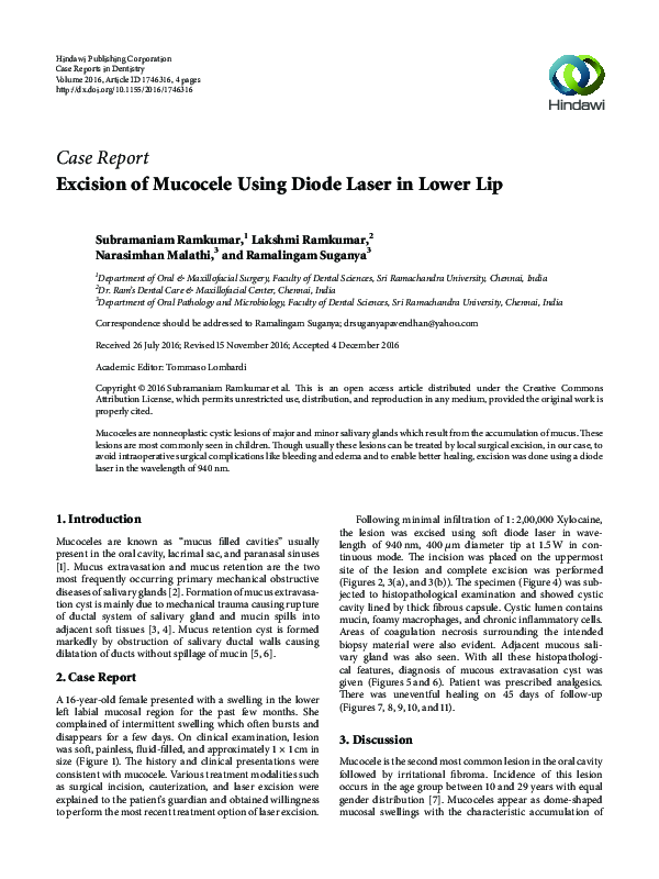 (PDF) Excision of Mucocele Using Diode Laser in Lower Lip