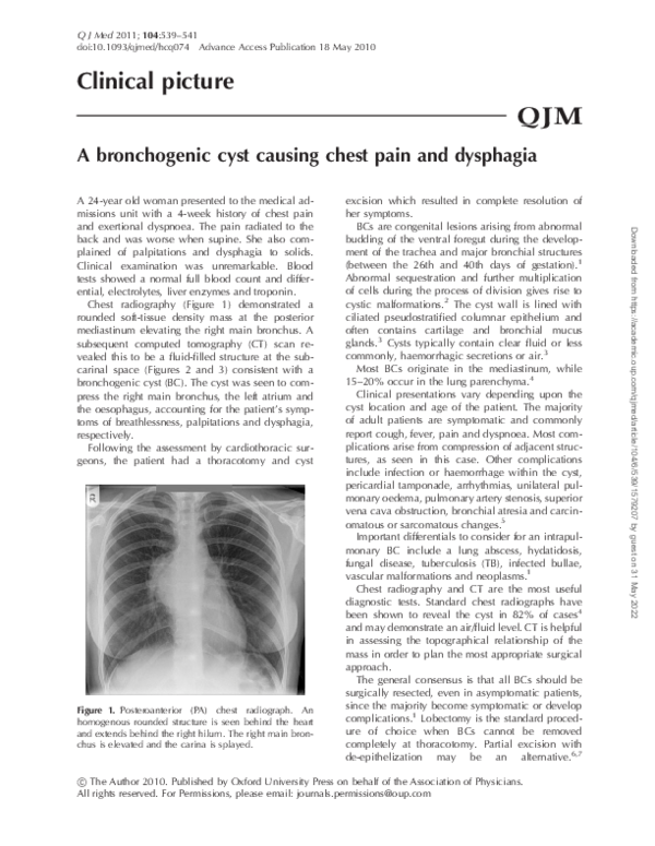 (PDF) A bronchogenic cyst causing chest pain and dysphagia