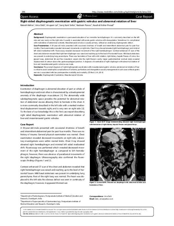 (PDF) Right-sided diaphragmatic eventration with gastric volvulus and ...