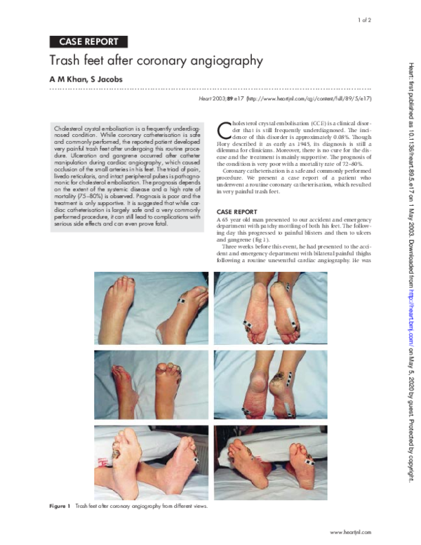 (PDF) Trash feet after coronary angiography