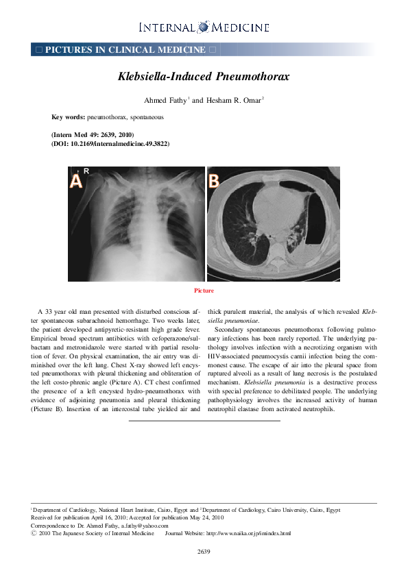 (PDF) Klebsiella-Induced Pneumothorax (PDF) Klebsiella-Induced Pneumothorax