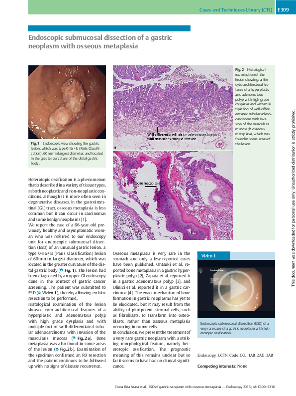 (PDF) Endoscopic Submucosal Dissection of Gastric Neoplasia Involving ...