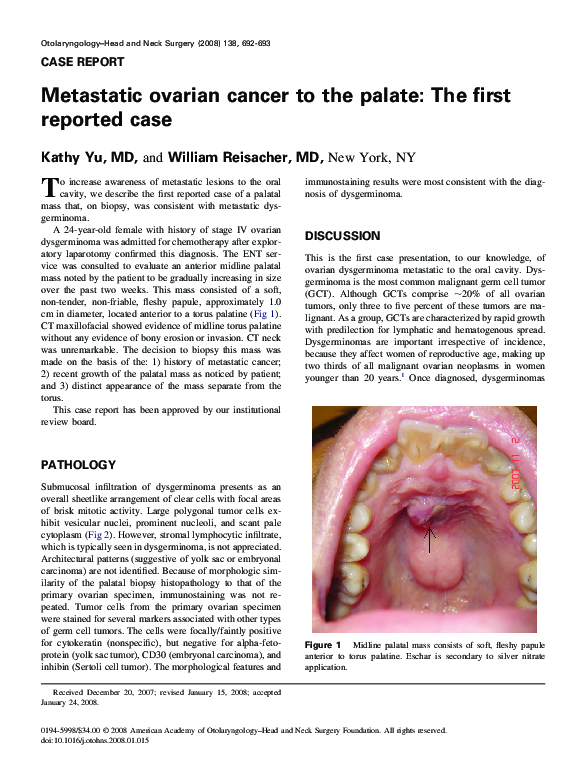 (PDF) Metastatic ovarian cancer to the palate: The first reported case