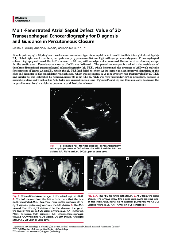 (PDF) Multi-Fenestrated Atrial Septal Defect: Value of 3D ...