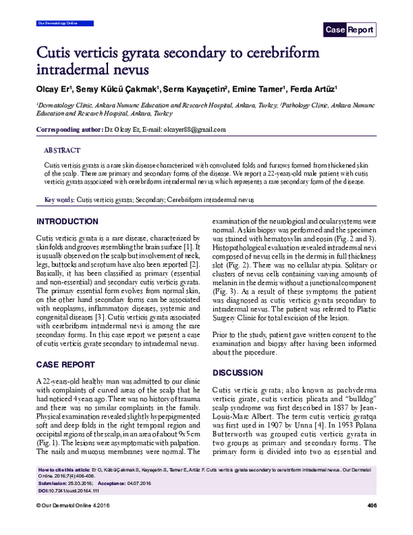 (PDF) Cutis verticis gyrata secondary to cerebriform intradermal nevus