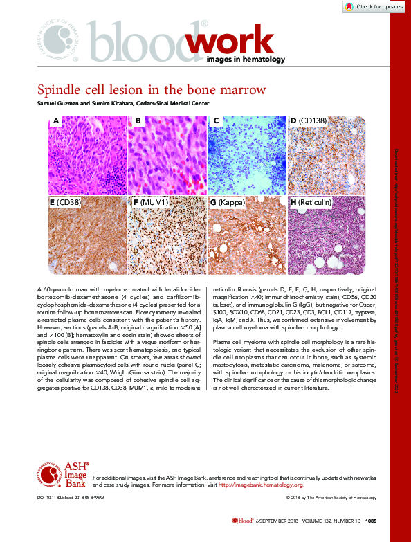 (PDF) Spindle cell lesion in the bone marrow