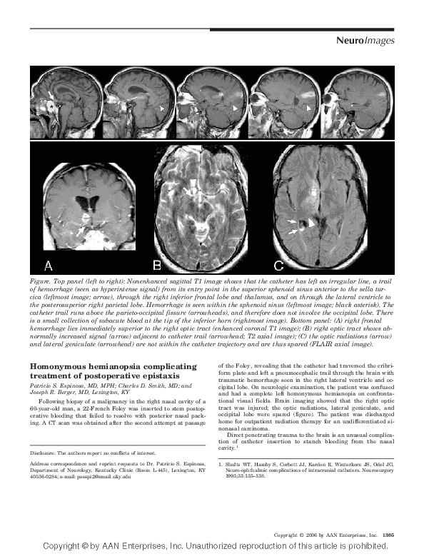 (PDF) Homonymous hemianopsia complicating treatment of postoperative ...