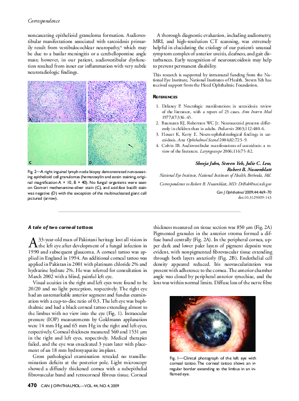 (PDF) A tale of two corneal tattoos | yeni yucel - Academia.edu