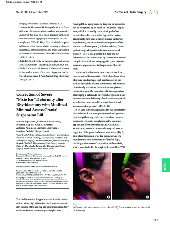 (PDF) Correction of Severe "Pixie Ear" Deformity after Rhytidectomy ...