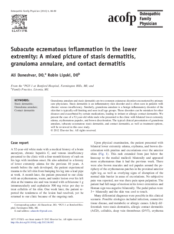 (PDF) Subacute eczematous inflammation in the lower extremity: A mixed ...