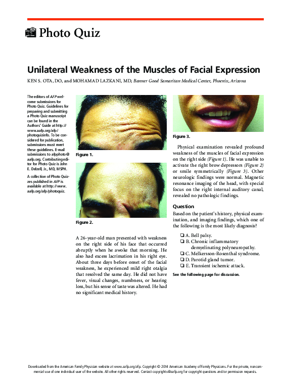 (PDF) Unilateral weakness of the muscles of facial expression