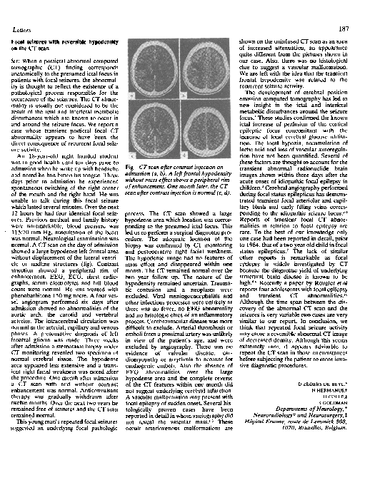 (PDF) Focal seizures with reversible hypodensity on the CT scan