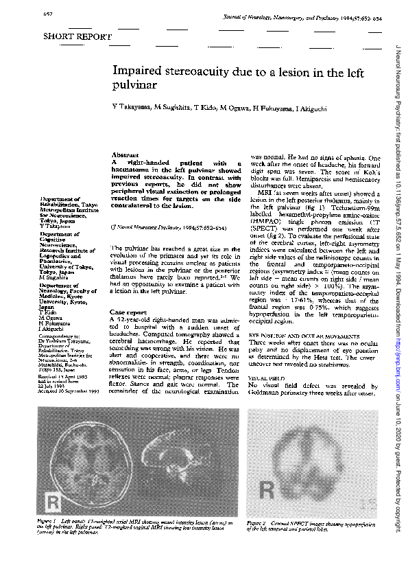 (PDF) Impaired stereoacuity due to a lesion in the left pulvinar ...